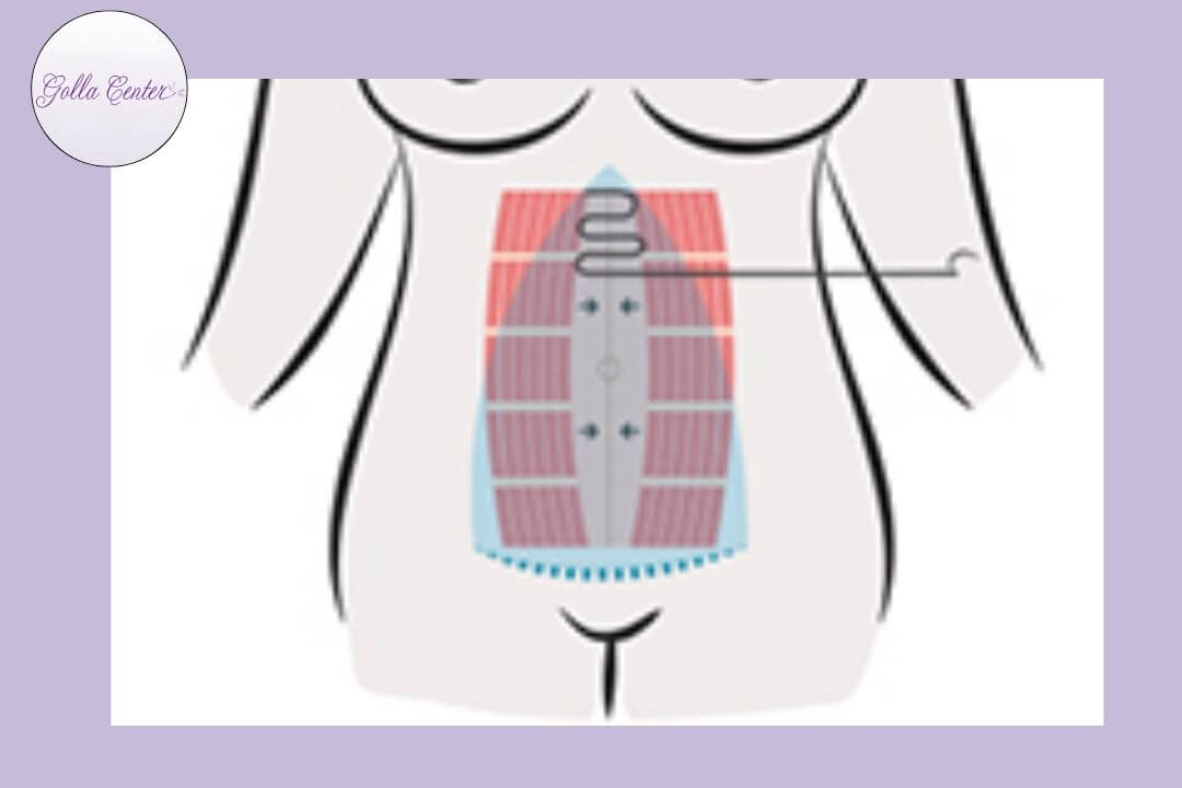 Tummy Tuck Surgery Pittsburgh, PA | Expert Abdominoplasty | Golla Center